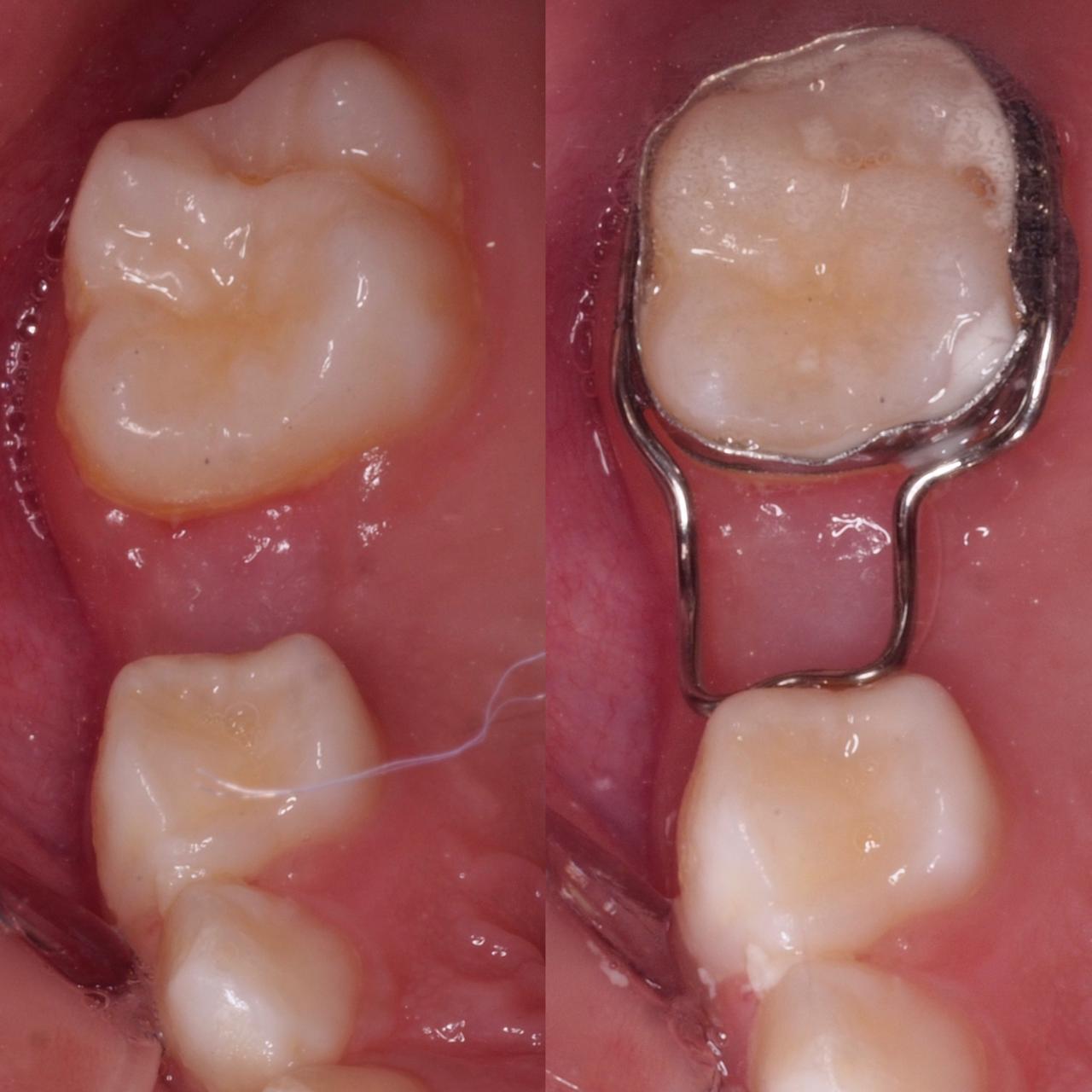 Space Maintainer – Beam Dental