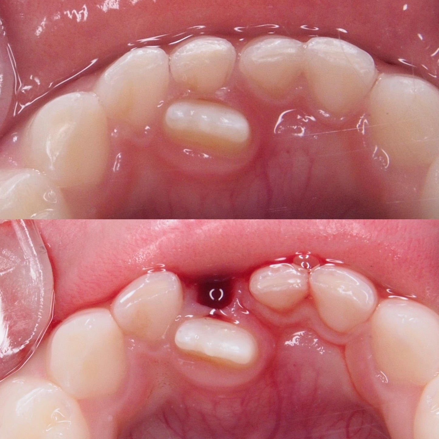 Kids Tooth Extraction (Pencabutan Gigi Anak) – Beam Dental